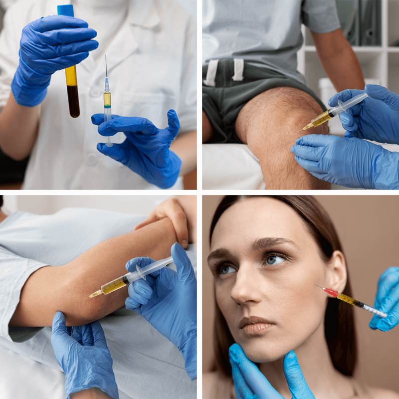 PRP TEDAVİSİ - Borfiz Fizik Tedavi ve Rehabilitasyon Tıp Merkezi